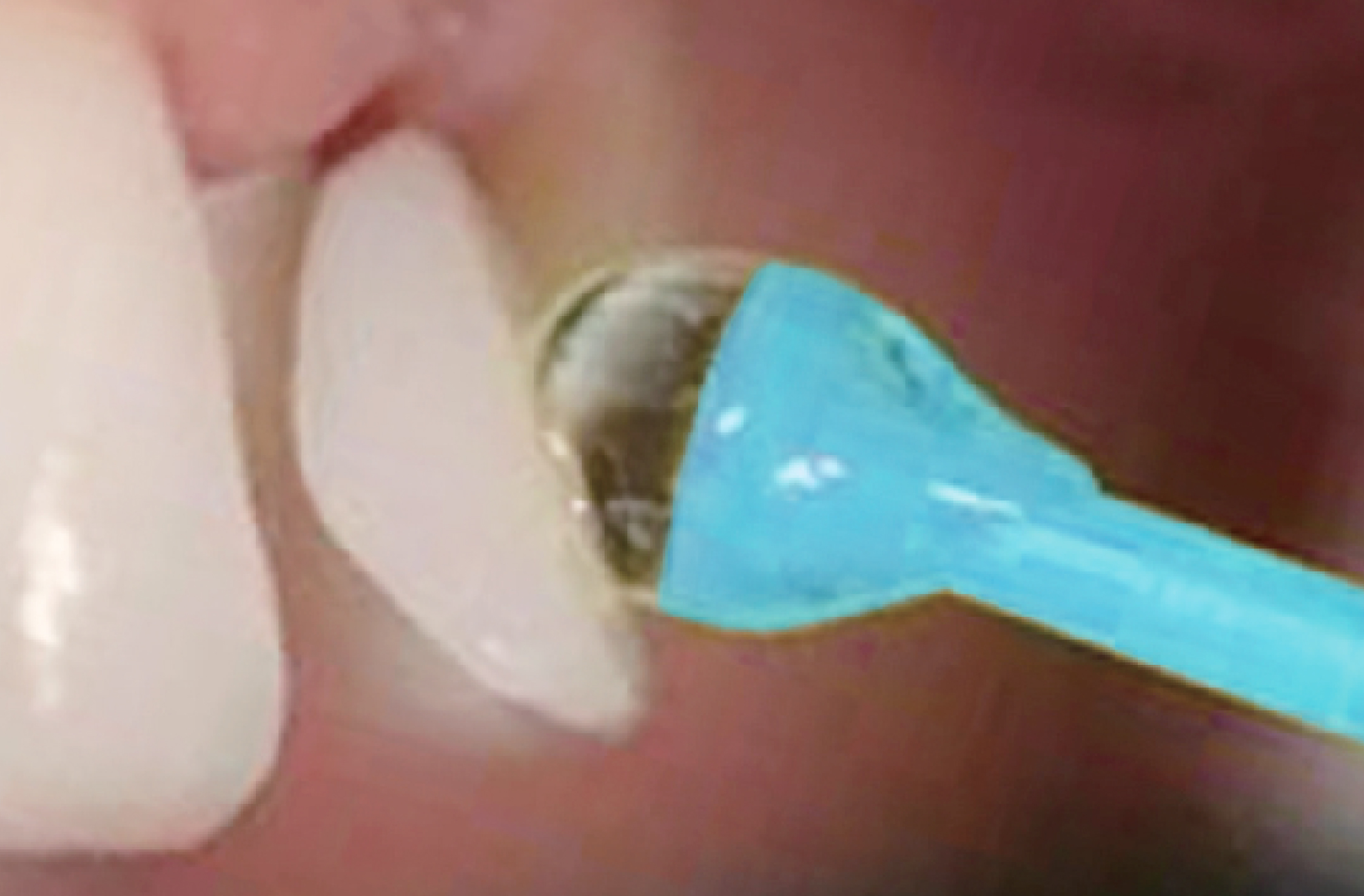 Adhesive Tip Applicator